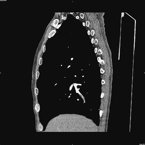 Unsuspected Pulmonary Embolism Identified Using Multidetector Computed