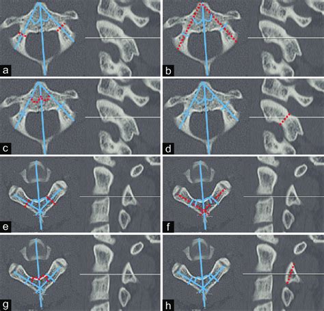 Measurement Techniques Of The Axis A Pedicle Width Dashed Line