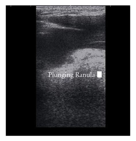 Ranula Ultrasound