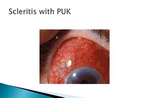 Scleritis Ppt
