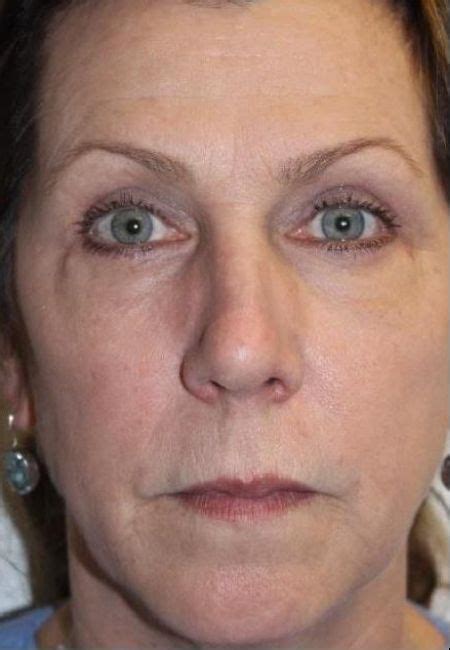 Laser Facial Resurfacing Case 2183 Malena Amato Md Facs