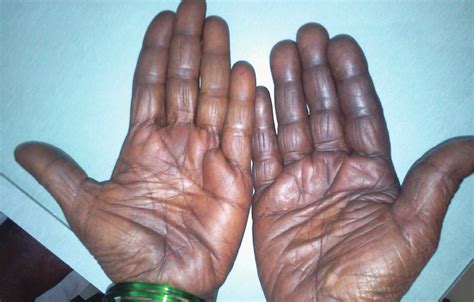 Photograph Shows Irregular Patches Of Hyperpigmentation Involving The