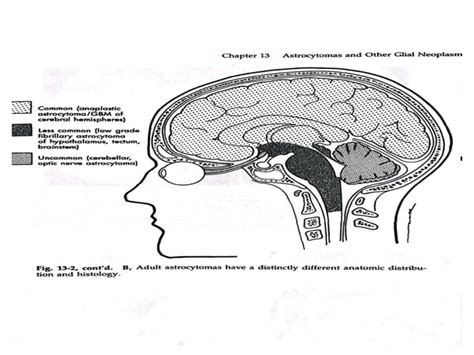 Diseases Of Brain Tumer Classification Of Brain Tumor Ppt