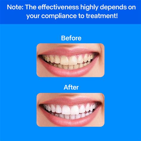 Introduction Of 5 Important Teeth Whitening Products In Oral Care And