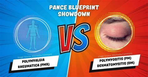 Pance Blueprint Comparisons You Need To Know Polymyalgia Rheumatica