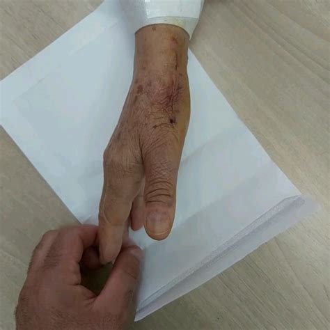 Mustafa Naamnih M D On Linkedin A 70 Year Old Female 2 Weeks After Cmcj 1 Arthroplasty Touch