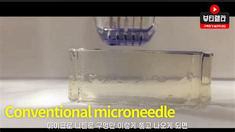 스킨부스터 포텐자 펌핑팁 Vs 인젝터 Vs Mts 비교 글 하나로 정리해드립니다 강남 신논현역 성형외과 피부과 맑고