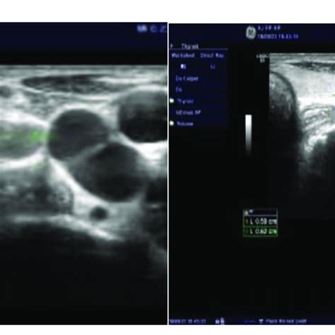 B Ultrasound Image Before Parathyroid Radiofrequency Ablation