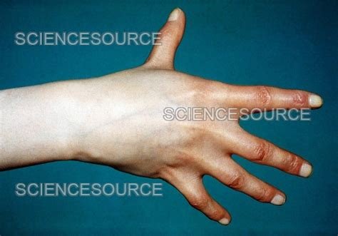 Klinefelters Syndrome Stock Image Science Source Images