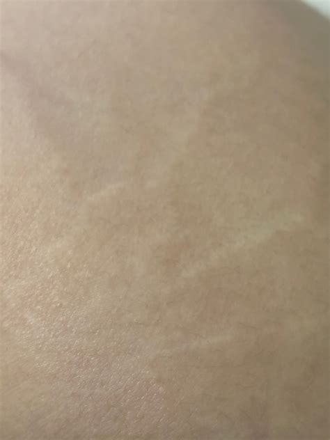 피부 기생충 지식in