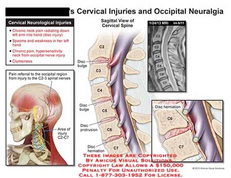 Cervical Injuries And Occipital Neuralgia