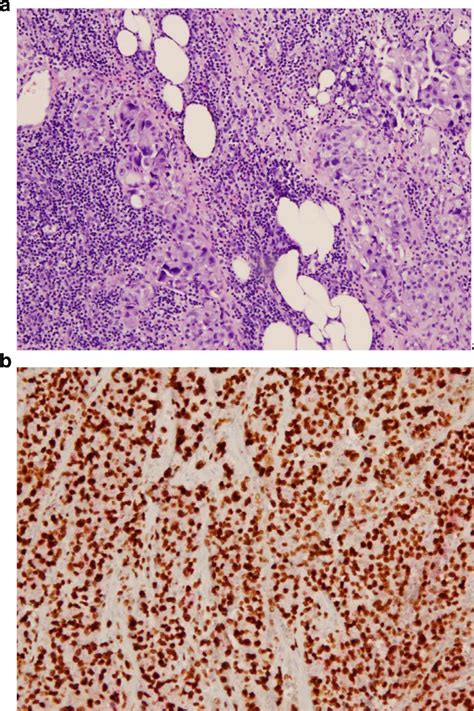 A Left Axillary Lymph Node Excision Revealed Metastatic Poorly Download Scientific Diagram