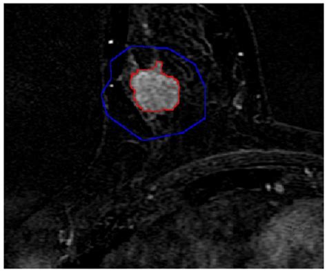 Semi Automatic Segmentation Result Of The Breast Lesion Based On The Download Scientific