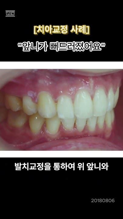 치아교정 앞니가 뻐드러졌어요 돌출의 교정치료 전후사진 포함신촌유앤아이치과 신촌교정 신촌치과 신촌역8번출구