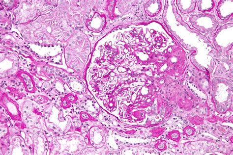 Focal Segmental Glomerulosclerosis Fsgs Clinical Cases Of Urinary System Saturn Medic