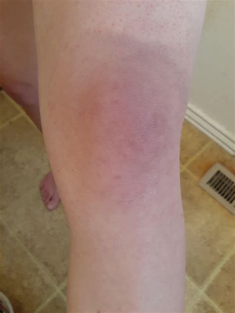 Does This Look Like Raynauds Or Poor Circulation Rraynauds