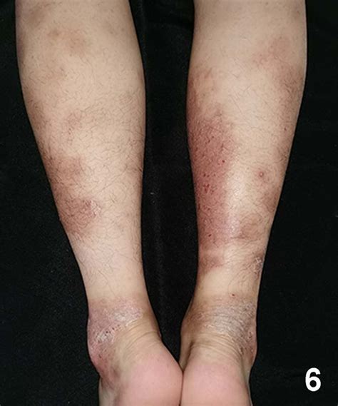 The Eruption On The Flexor Aspects Of Lower Limbs Showed Significant