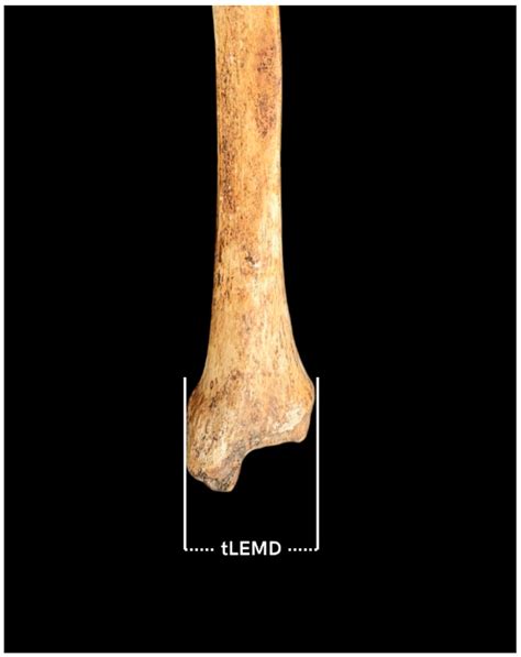 Sex Estimation From The Fibula And Tibia A Study In Three Portuguese Reference Collections