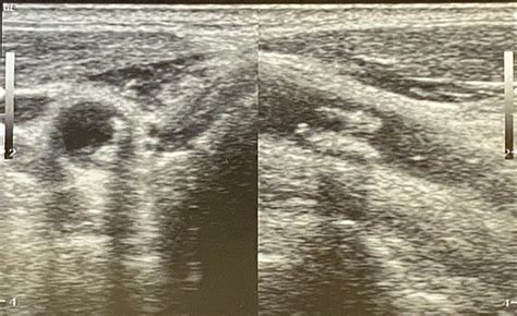 Plak Aterosklerosis Di Arteri Karotis Manusia Foto Stok Unduh Gambar Sekarang Alat Medis