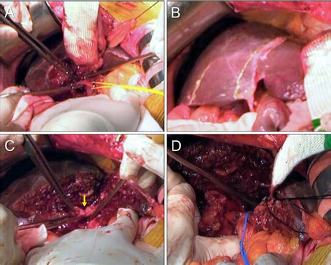 Intraoperative Photographs Showing The Surgical Procedure For Resection