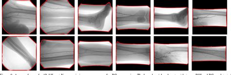 Figure 9 From Diagnostically Lossless Coding Of X Ray Angiography Images Based On Background