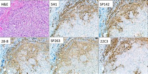 Figure 1 From Pd L1 Expression In Melanoma A Quantitative