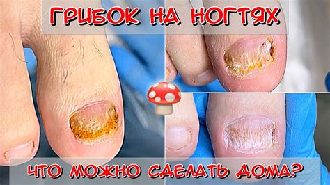 Грибок ногтей / Чем ухаживать дома при грибке ногтей? / Подология ...