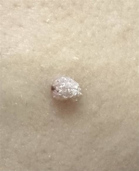 [잡담] 내 볼에 난 거 뮤ㅜ야 인스티즈 Instiz 일상 카테고리