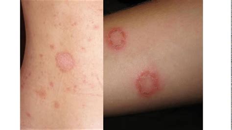 Fungal Infections On Skin Youtube
