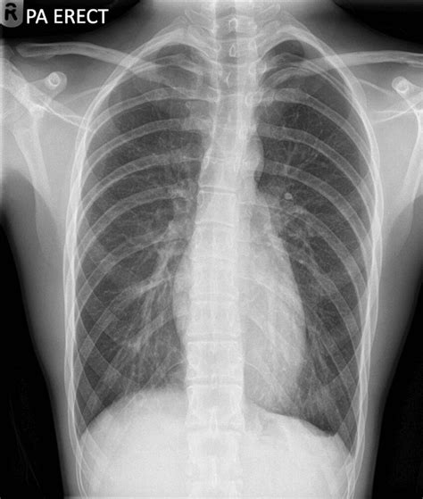 Initial Cxr Demonstrating A Small Apical Left Sided Pneumothorax Download Scientific Diagram