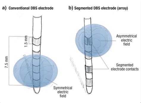 Different Varieties Of Dbs Electrode Dbs Deep Brain Stimulation A