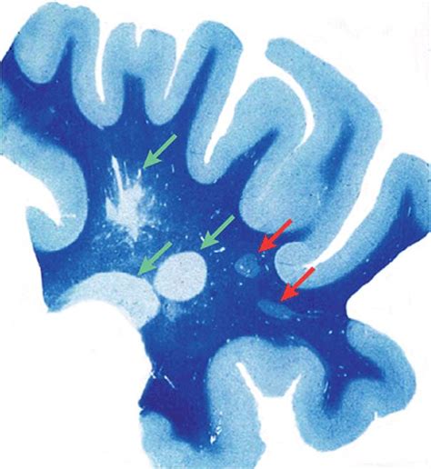 Figure 1 From Remyelination In Multiple Sclerosis Semantic Scholar