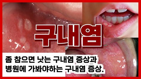 병원에 가봐야 하는 구내염 Youtube