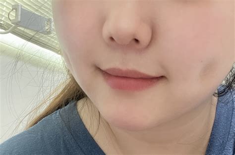 보조개 수술 시술 1일차~8일차 솔직후기 네이버 블로그