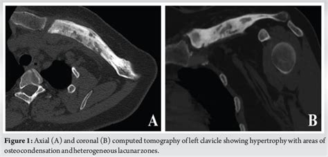 Spontaneous Clavicular Osteomyelitis Caused By Cutibacterium Acnes