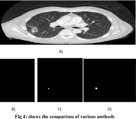 Figure 4 From Lung Lesion Extraction Using Improved Toboggan Based Algorithm Semantic Scholar