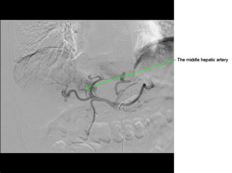 The Pump And The Tubes Middle Hepatic Artery