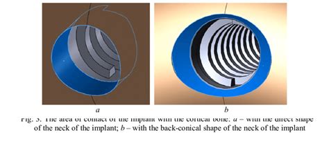 Models Of Implants Frontal And Lateral Sections Of The Jaw A