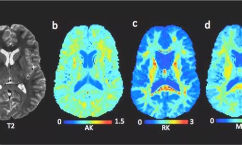 Diffusion Kurtosis Imaging Can Identify Cognitive Impairment In