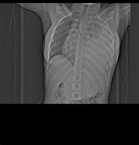 Tension Hydrothorax Rradiology