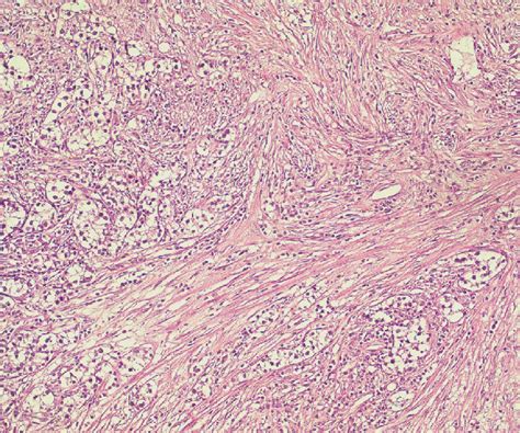Parathyroid Tissue With Proliferation Of Clear Cells With Download Scientific Diagram