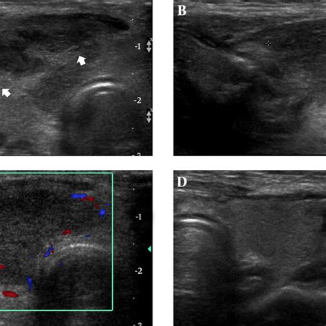 Technetium 99m Pertechnetate Thyroid Scan Shows Large Photon Defects Of