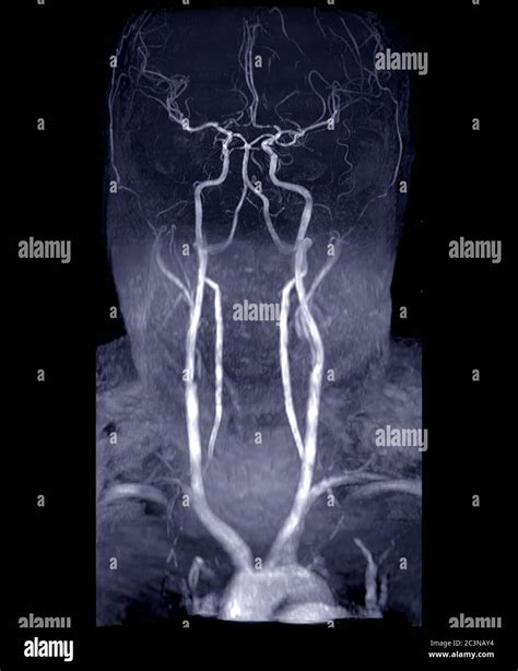 Mra Brain And Neck Or Magnetic Resonance Angiography Mra Of Cerebral Artery And Common