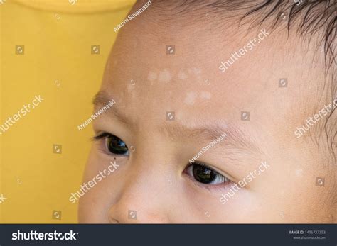 Fungal Infection On Face White Patches At Danelle Perez Blog