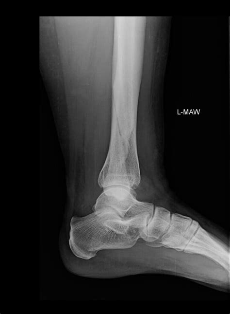 Orthodx Ankle Fracture In Young Woman Clinical Advisor
