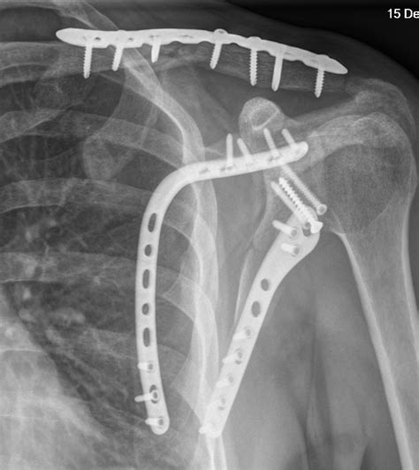 Shoulder And Elbow Fracture Treatment Mr Jagwant Singh