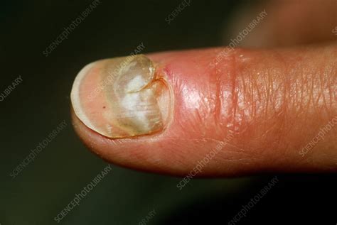 Damaged Fingernail Stock Image C0048335 Science Photo Library