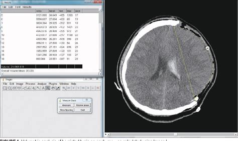 Figure 1 From Addition Of Resection Of Temporal Muscle And Fascia In