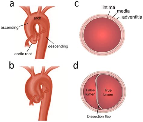Ascending And Arch Aortic Aneurysms And Dissection Rmdrki