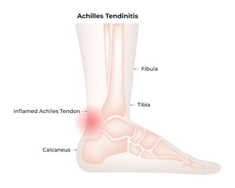Tibia Fibula Vectors And Illustrations For Free Download